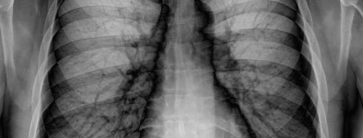 MFD Veselības grupa – Esi vesels! | Bezmaksas plaušu rentgens